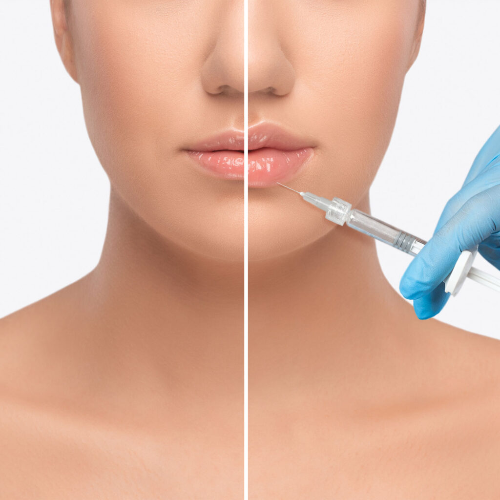 Filler: Kysse - Cypress Dermatology